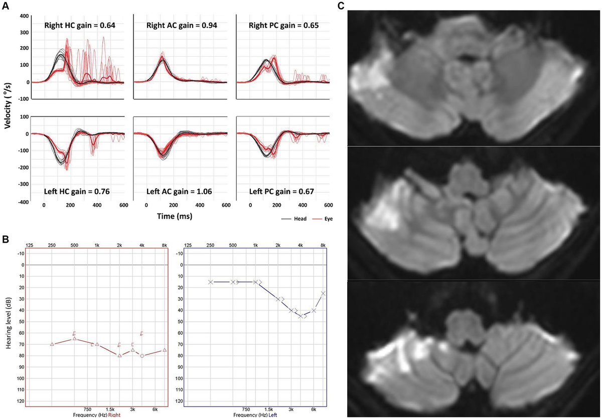 Frontiers | Bilaterally positive head-impulse tests can differentiate ...