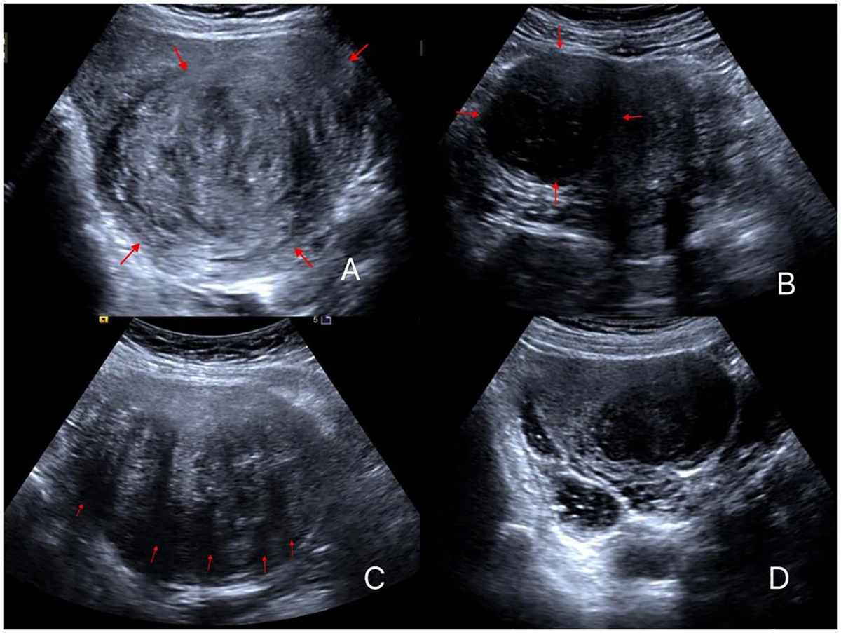 Frontiers | Sonographic features of uterine fibroids that predict the ...