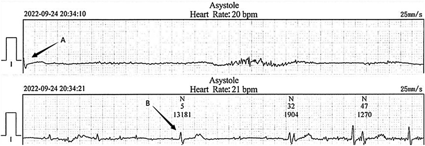 Frontiers | Cardioneuroablation eliminating cardiac asystole associated ...