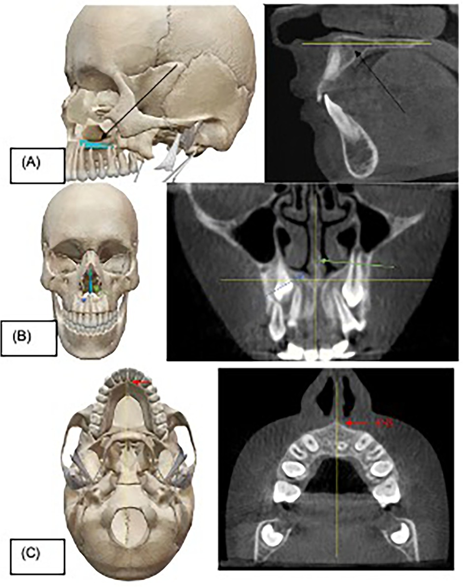 Frontiers | Assessment of root resorption on lateral incisors after ...