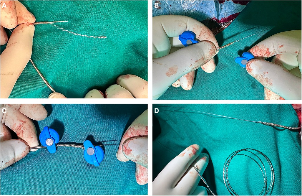 Frontiers | Case Report: Extraction of a stylet-driven lead for left ...