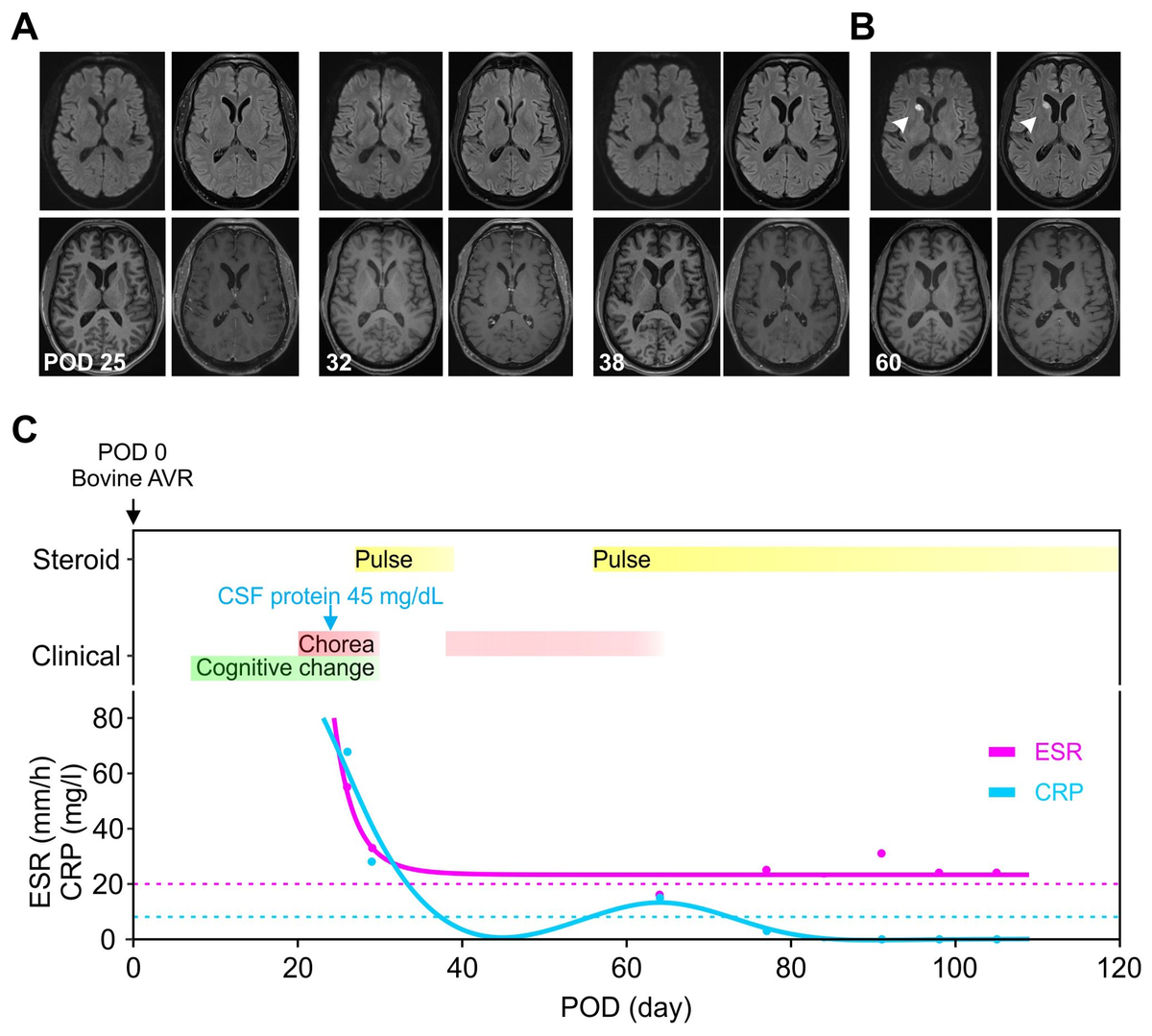Frontiers | The known and unknown of post-pump chorea: a case report on ...