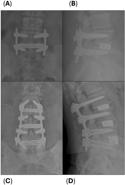 Frontiers | An innovative advance in bone grafting: initial clinical ...