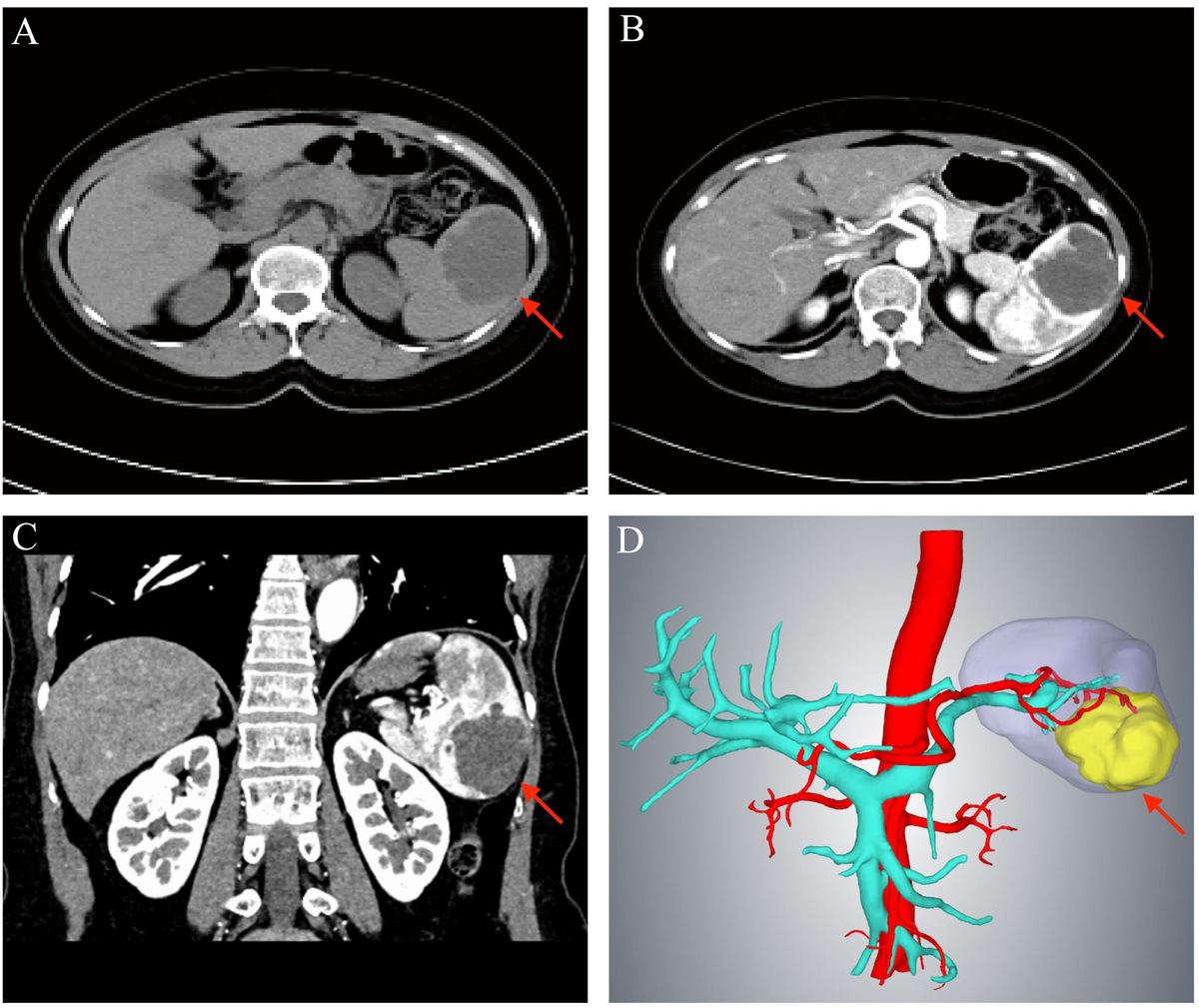 Frontiers | Laparoscopic anatomical partial splenectomy for extremely ...