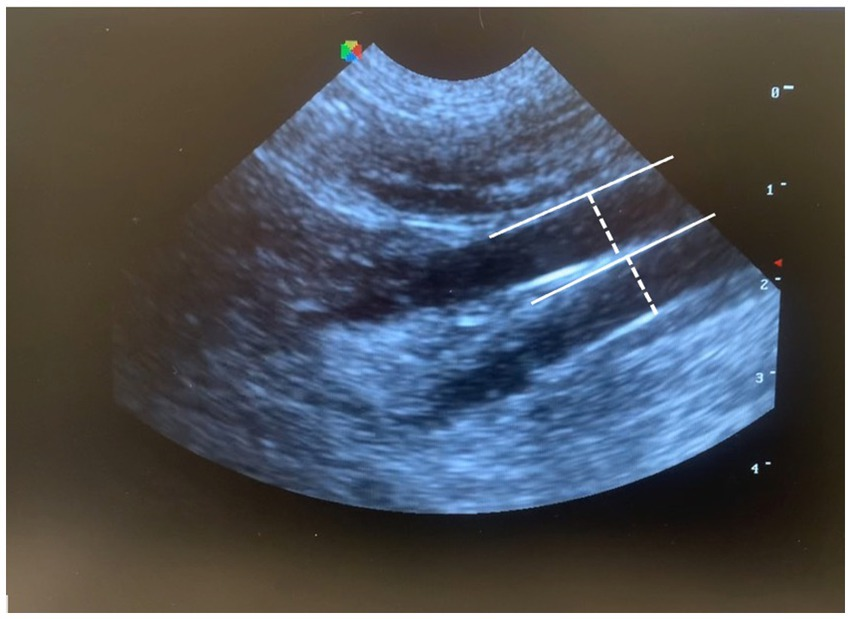 Frontiers | Point of care ultrasound measurement of paralumbar caudal ...