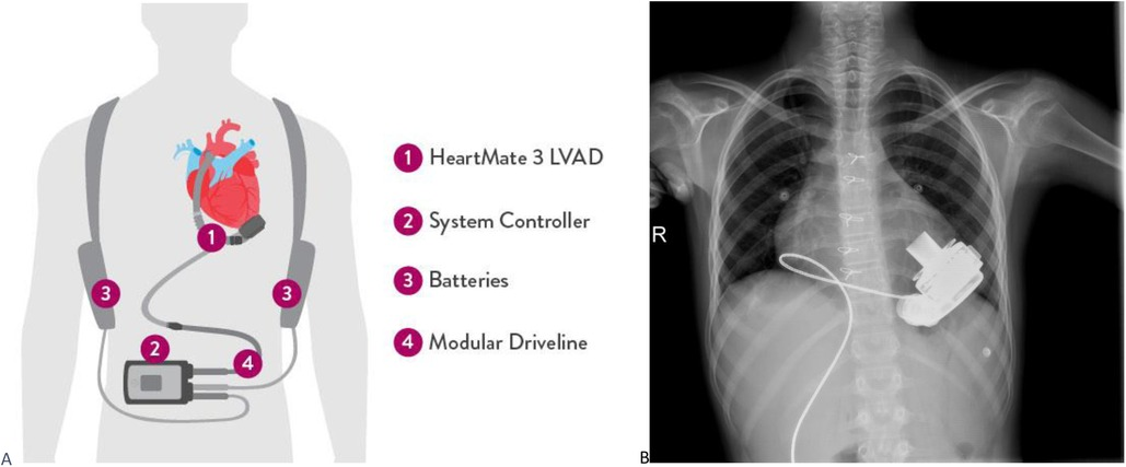 Frontiers | Outcomes of HeartMate 3 in pediatric patients with end ...
