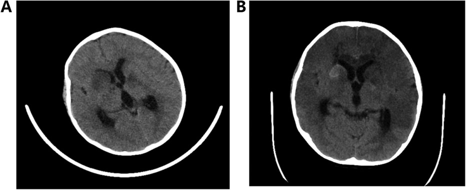 Frontiers | Paroxysmal sympathetic hyperactivity syndrome caused by ...