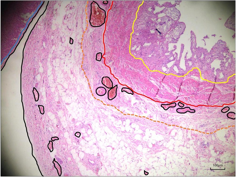 Frontiers | Cystic plate approach in laparoscopic cholecystectomy: a ...