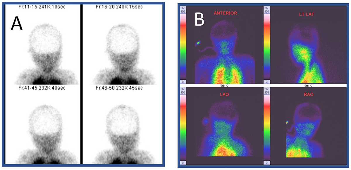 Frontiers | Ancillary tests for brain death