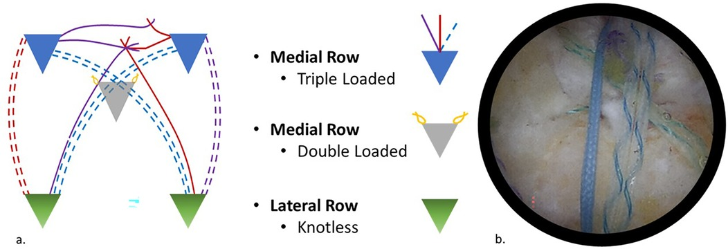 Frontiers | Rethinking rotator cuff repair: a critical opinion on the ...