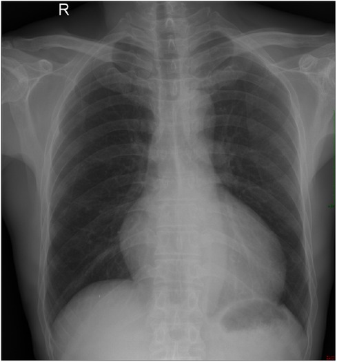 Frontiers | A simple goiter of the right ventricle: case report and ...
