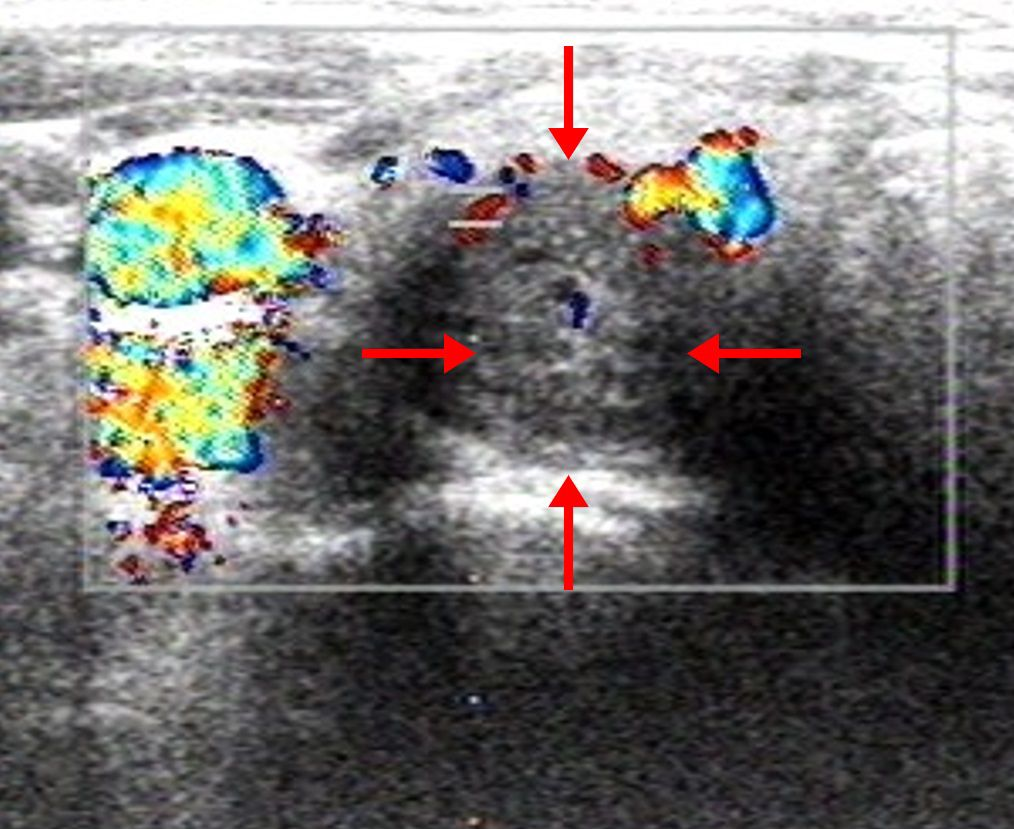Frontiers | Diagnostic value of Tc-99m-MIBI SPECT/CT in parathyroid ...