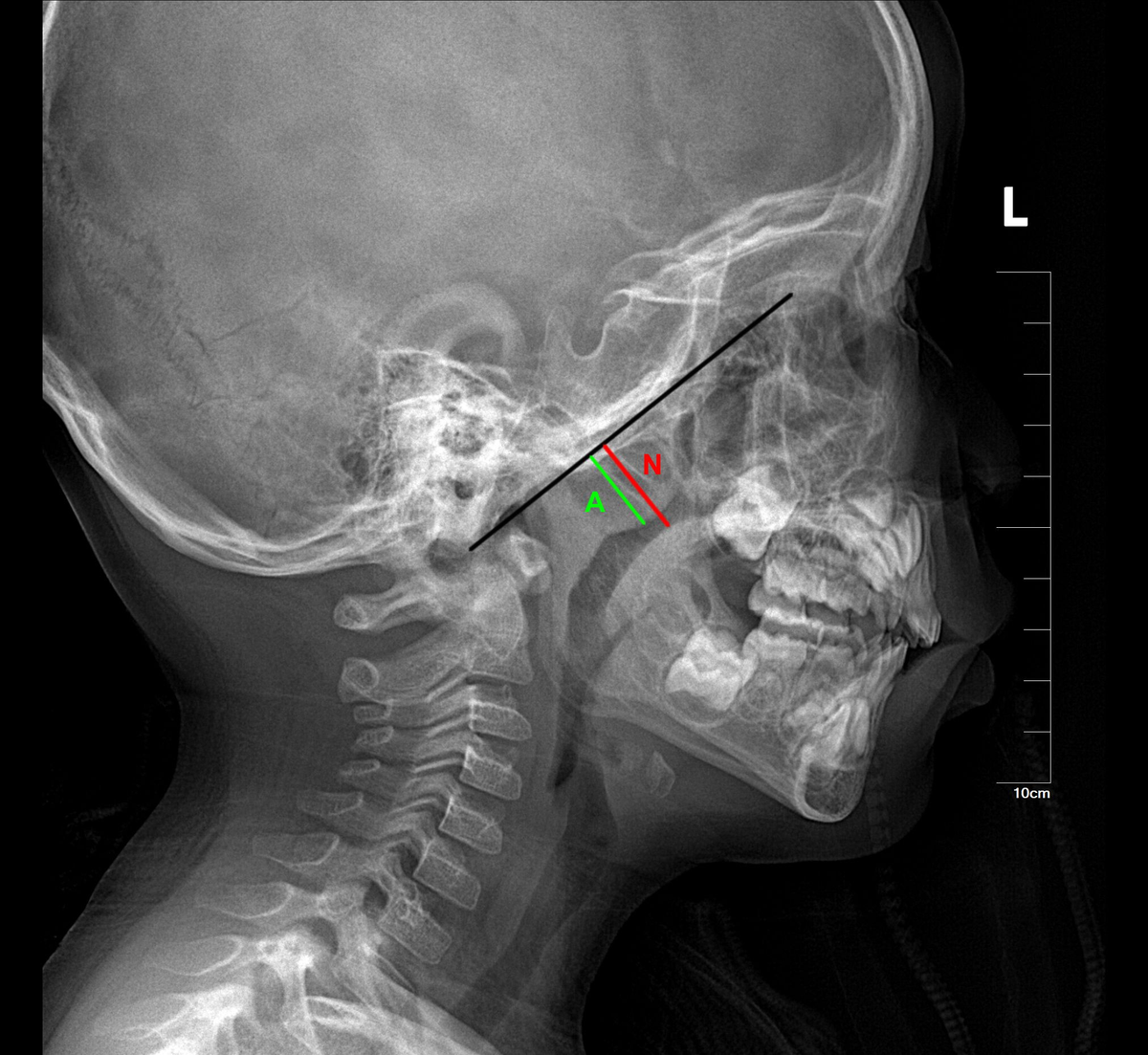 Frontiers | Optimized deep learning model for diagnosing tonsil and ...