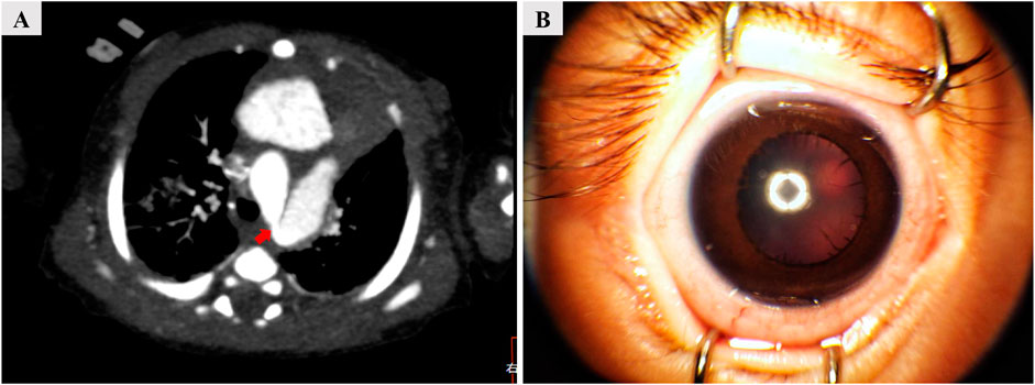 Frontiers | Case report: Multisystemic smooth muscle dysfunction ...