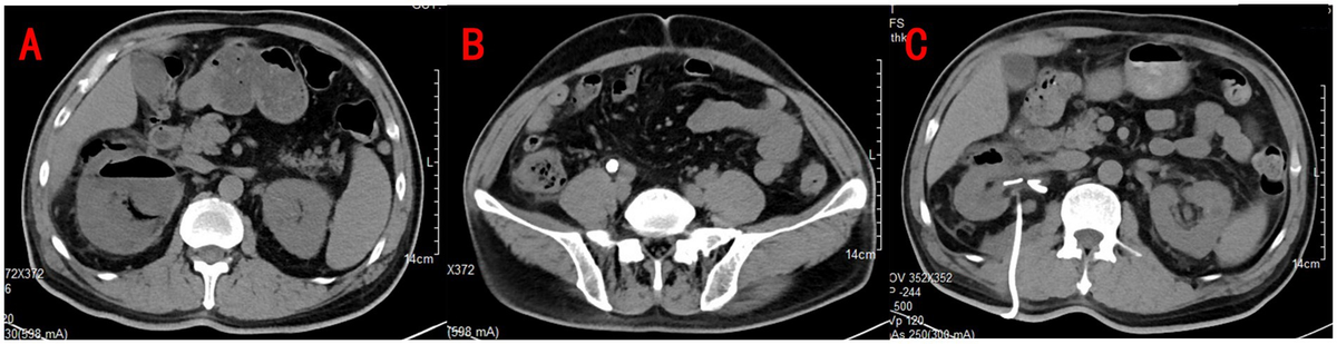 Frontiers | Emphysematous pyelonephritis with rare and severe iliac ...