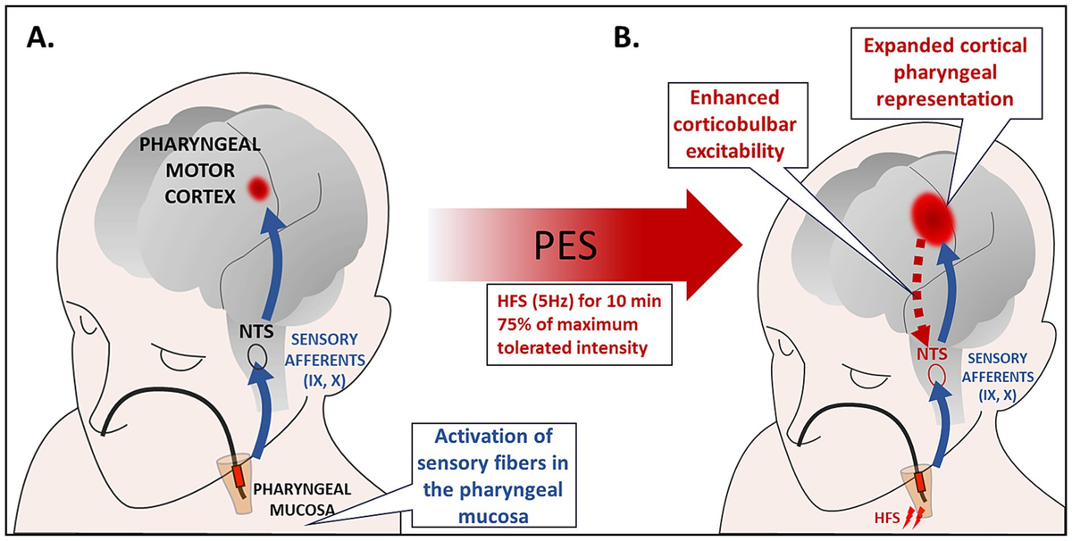 Frontiers | Dysphagia in multiple sclerosis: pathophysiology ...