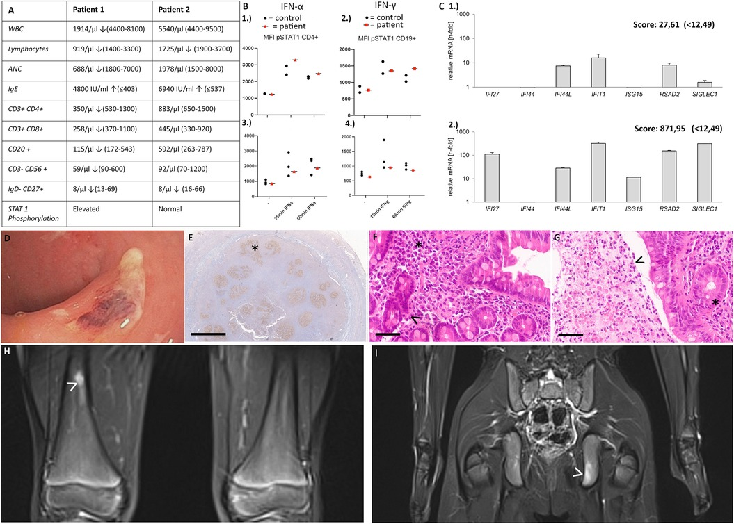 Frontiers | SOCS1 deficiency—crossroads of autoimmunity and ...