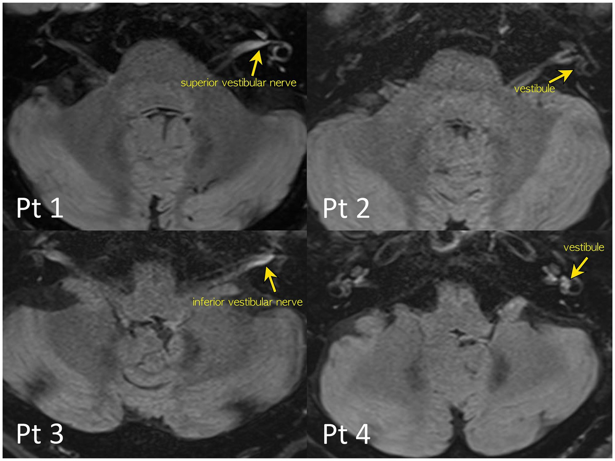 Frontiers | Selective otolithic dysfunction in patients presenting with ...