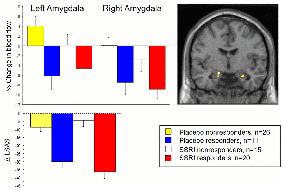 Frontiers | Revisiting the SSRI vs. placebo debate in the treatment of ...