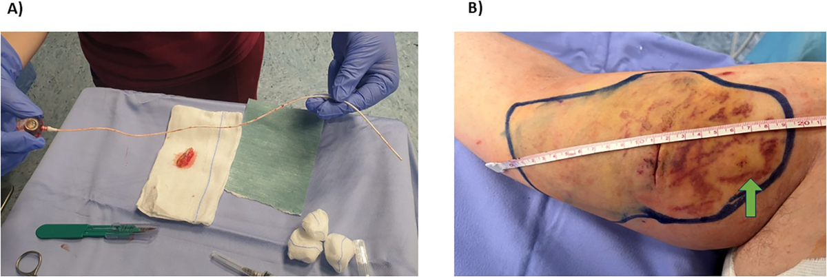 Frontiers | Case Report: A successful multidisciplinary approach to ...