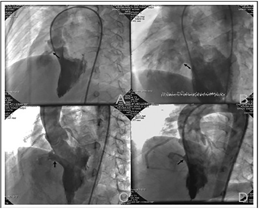 Frontiers | Early and mid-term outcomes of transcatheter closure of ...