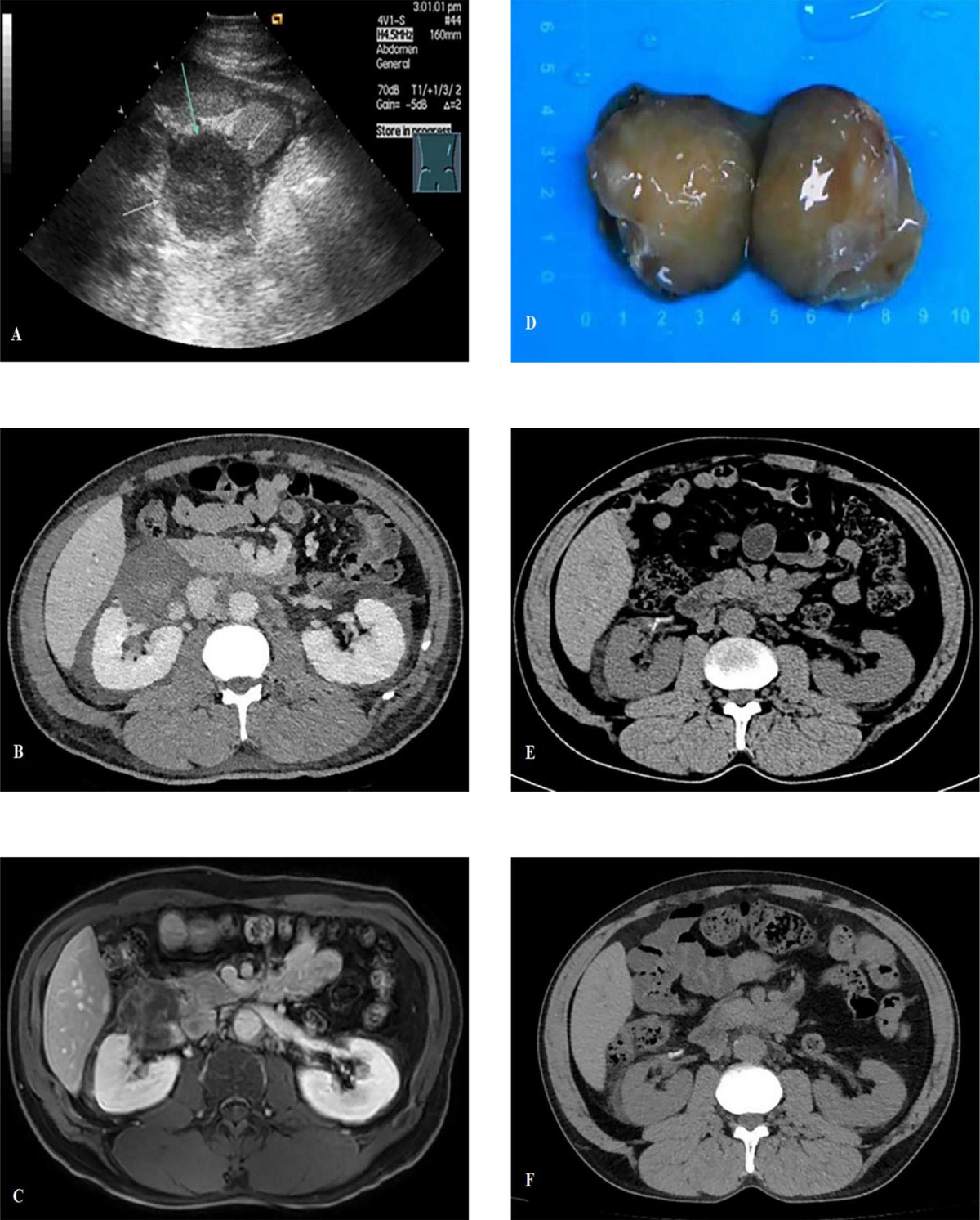 Frontiers | Perinephric myxoid pseudotumor of fat: the first case ...