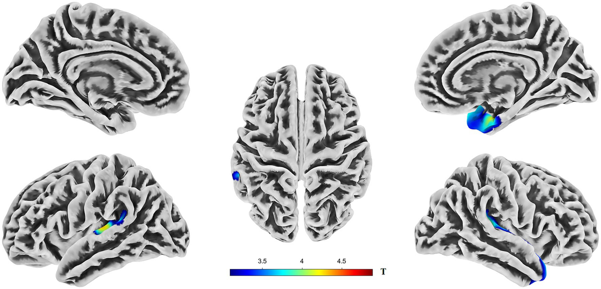 Frontiers | Voxel- and surface-based morphometry in the cortical ...