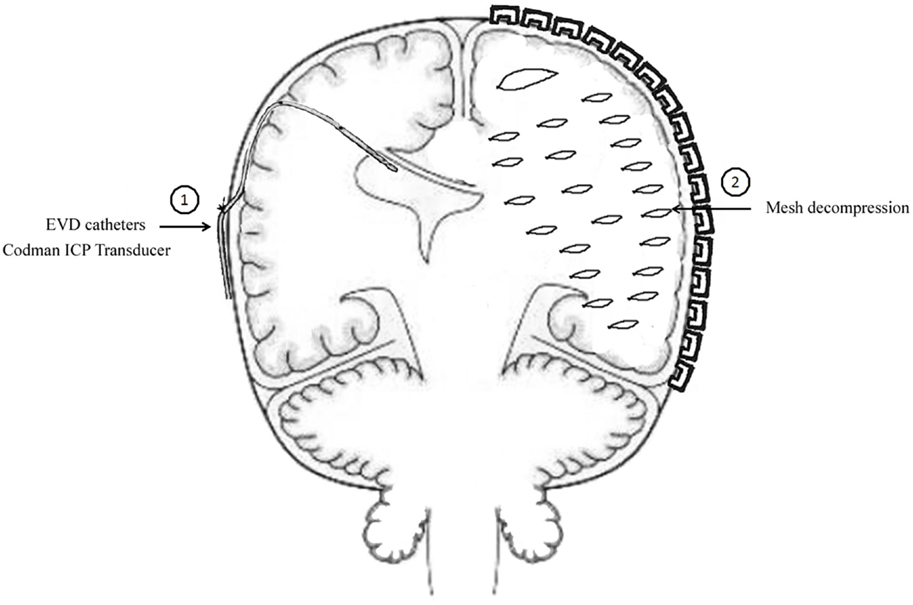 Frontiers | Technique of Stepwise Intracranial Decompression Combined ...