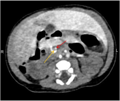 Frontiers | Congenital intestinal malrotation, duodenal obstruction ...