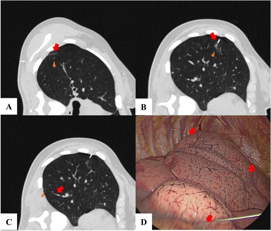 Frontiers | Non-inferiority comparison of medical glue and Frontiers | Non-inferiority comparison of medical glue and