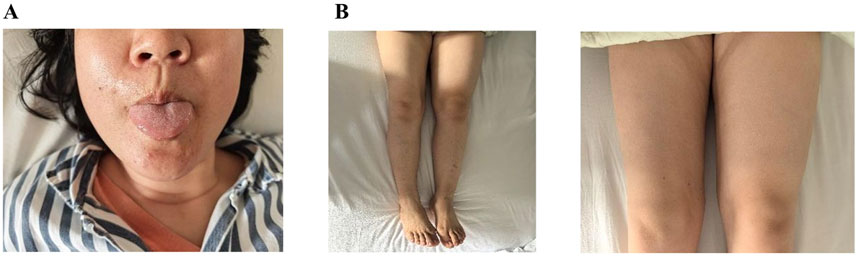 Frontiers | Case Report: A case of ALS type 6 associated with a FUS ...