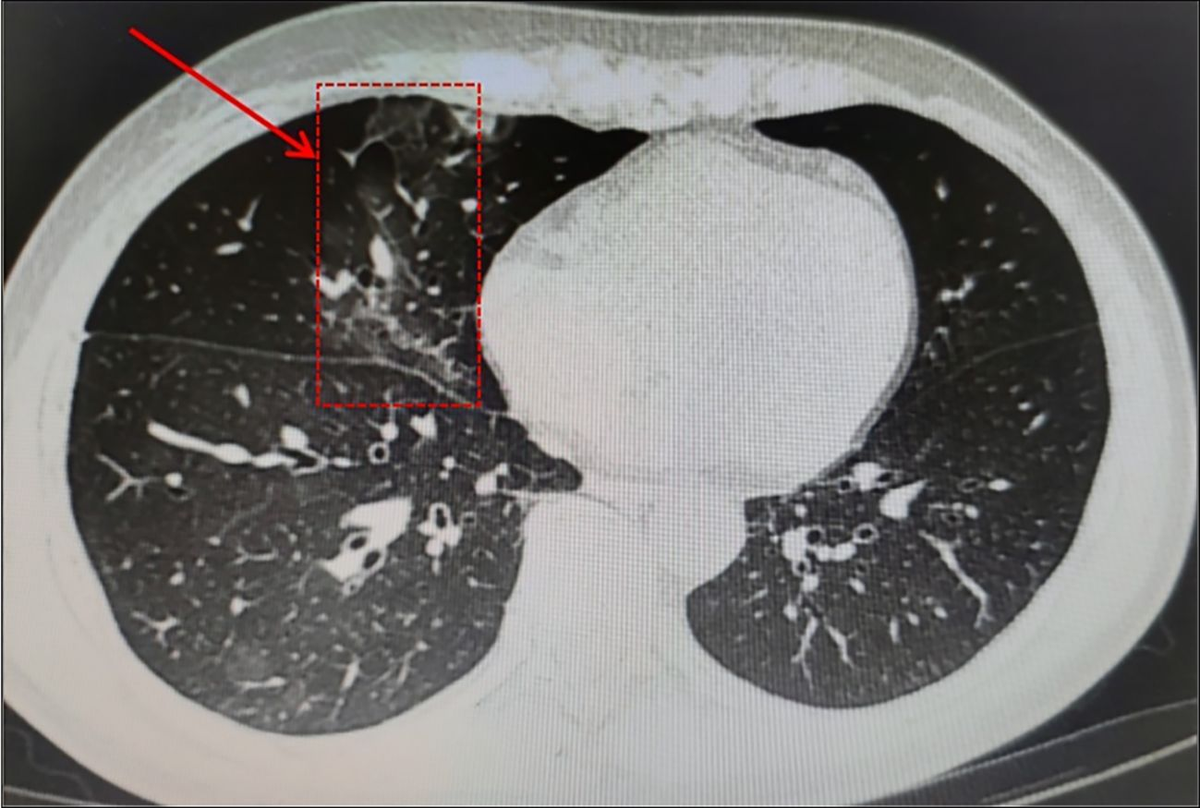 Frontiers | Case Report: Simnotrelvir/Ritonavir are effective in ...