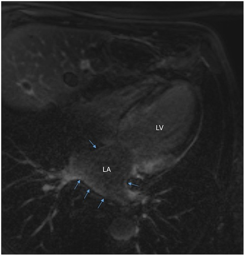 Frontiers | Effect of catheter ablation with vein of Marshall ethanol ...