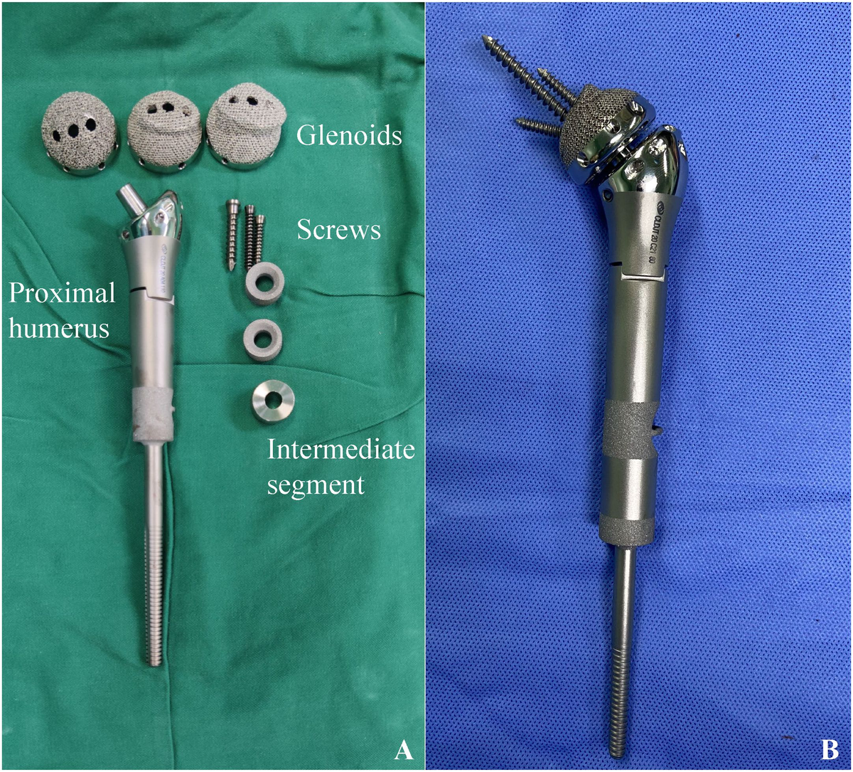 Frontiers | The utilization of 3D-printed arthrodesis prostheses in the ...