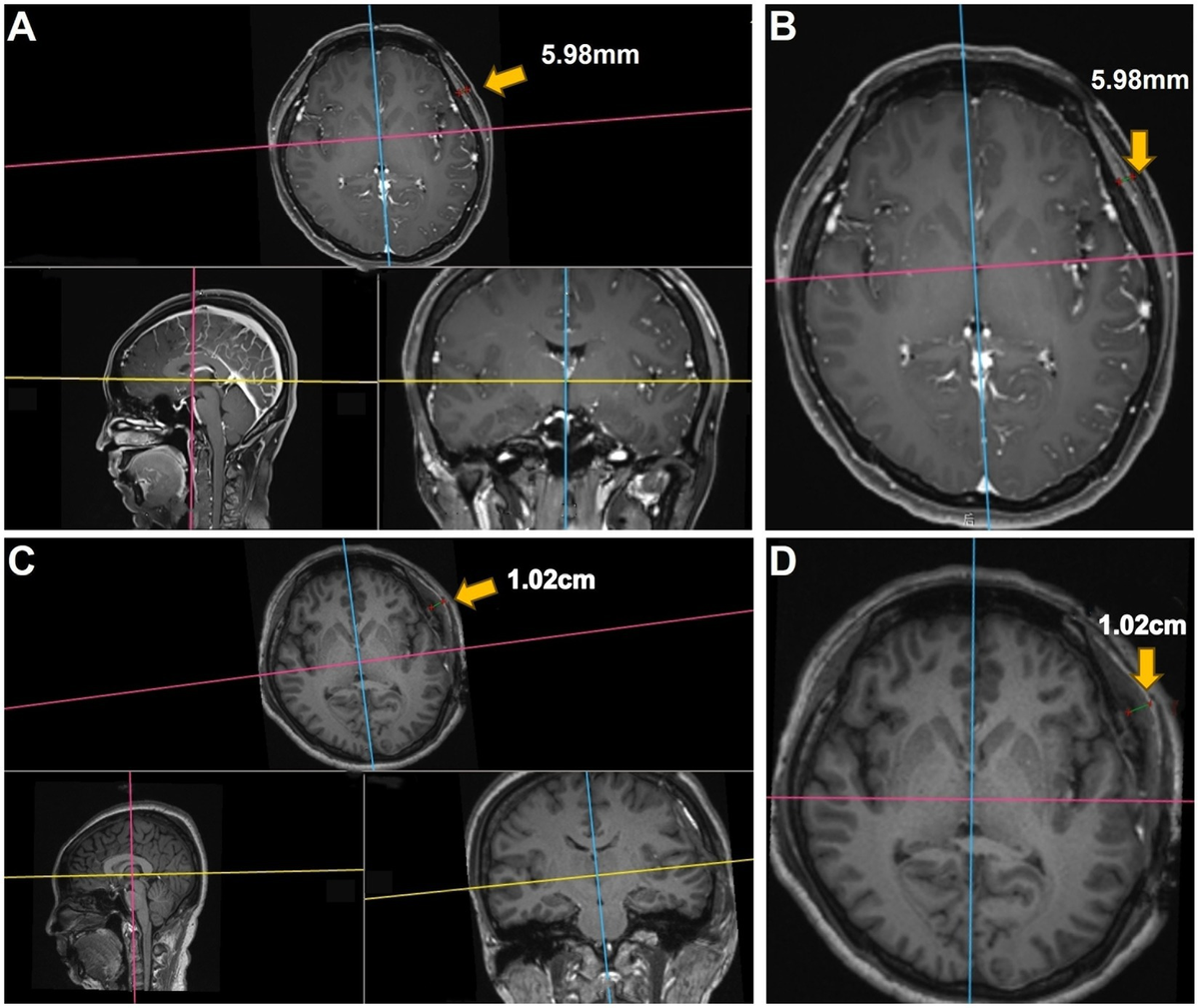 Frontiers | Temporal muscle thickness as a preoperative predictor of ...