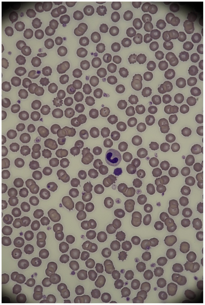 Frontiers | Prevalence of hyposegmentation of granulocytes/Pelger-Huët ...