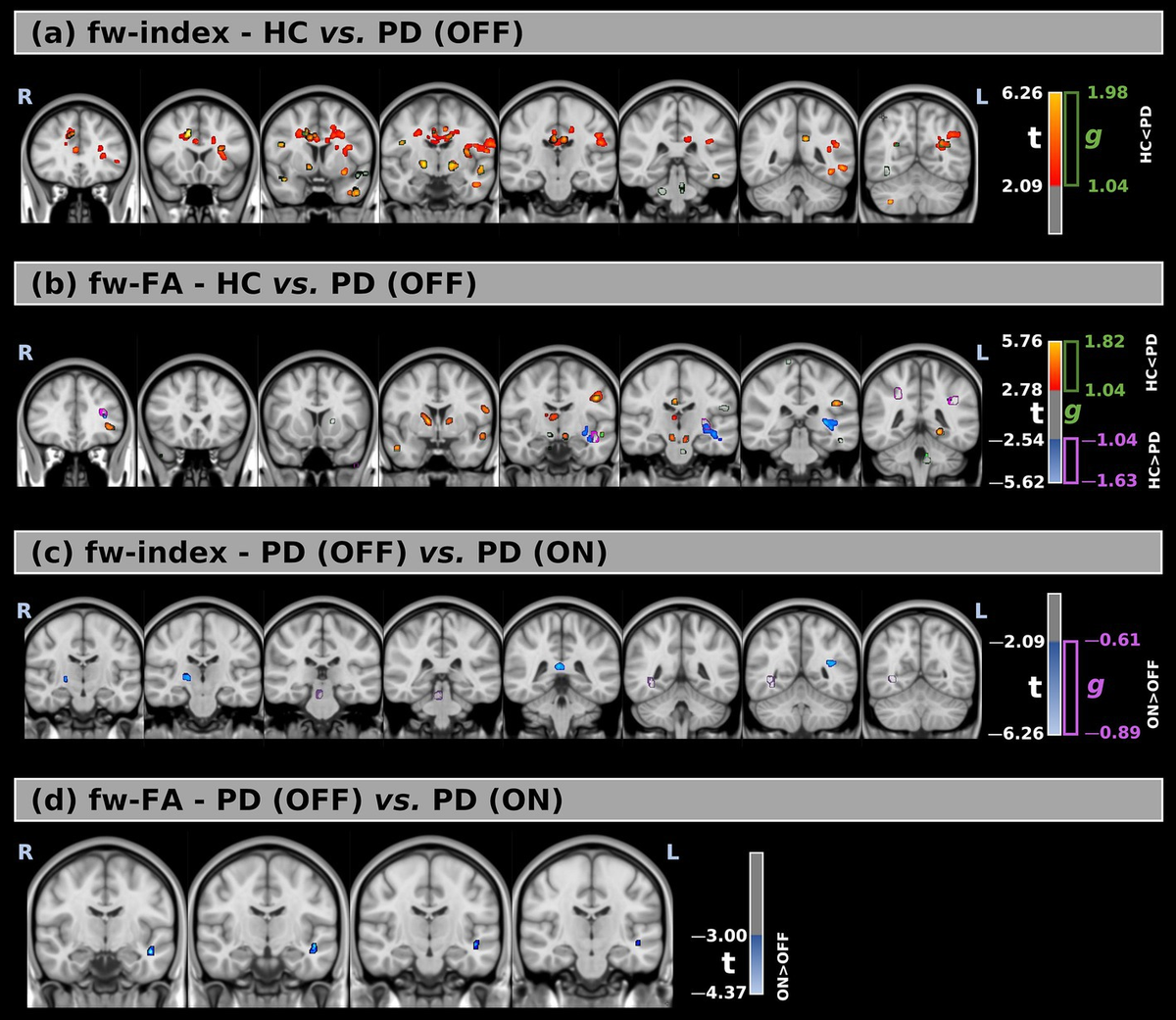 Frontiers | Investigating white matter alterations in Parkinson’s ...