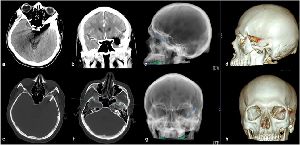 Frontiers | Surgical cure of intractable epilepsy caused by retained ...