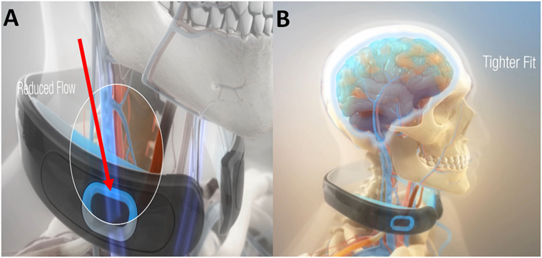 Frontiers | The Effects of External Jugular Compression Applied during ...