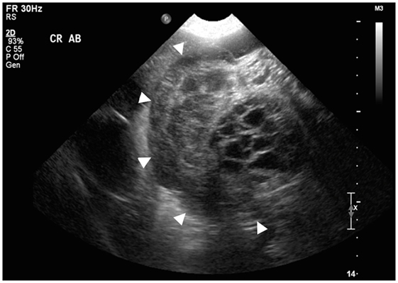 Frontiers | Computed Tomographic Features in a Case of Bilateral ...