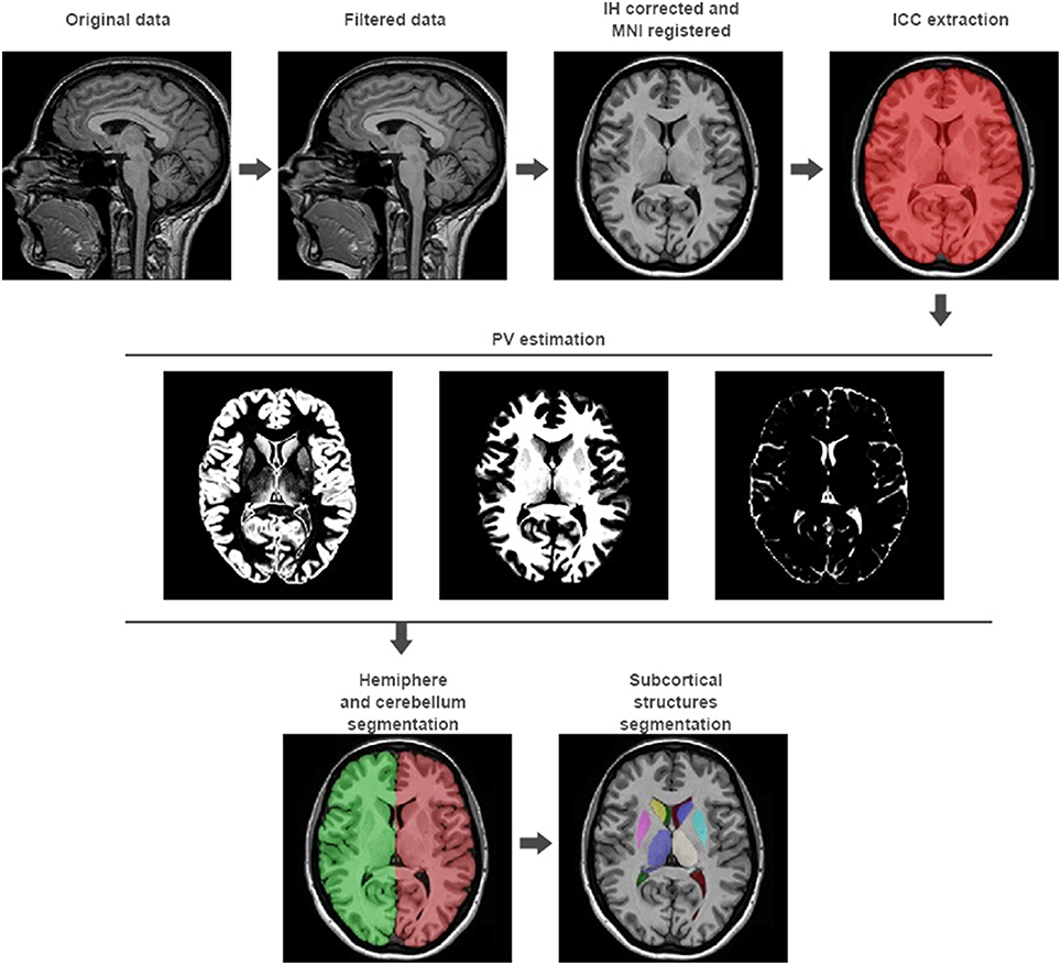 Frontiers | volBrain: An Online MRI Brain Volumetry System