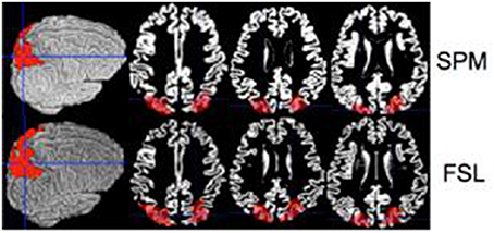 Frontiers | Reproducibility and Bias in Healthy Brain Segmentation ...