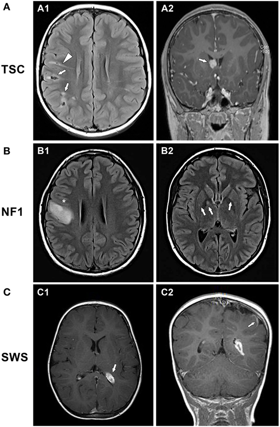 Frontiers | Epilepsy Mechanisms in Neurocutaneous Disorders: Tuberous ...
