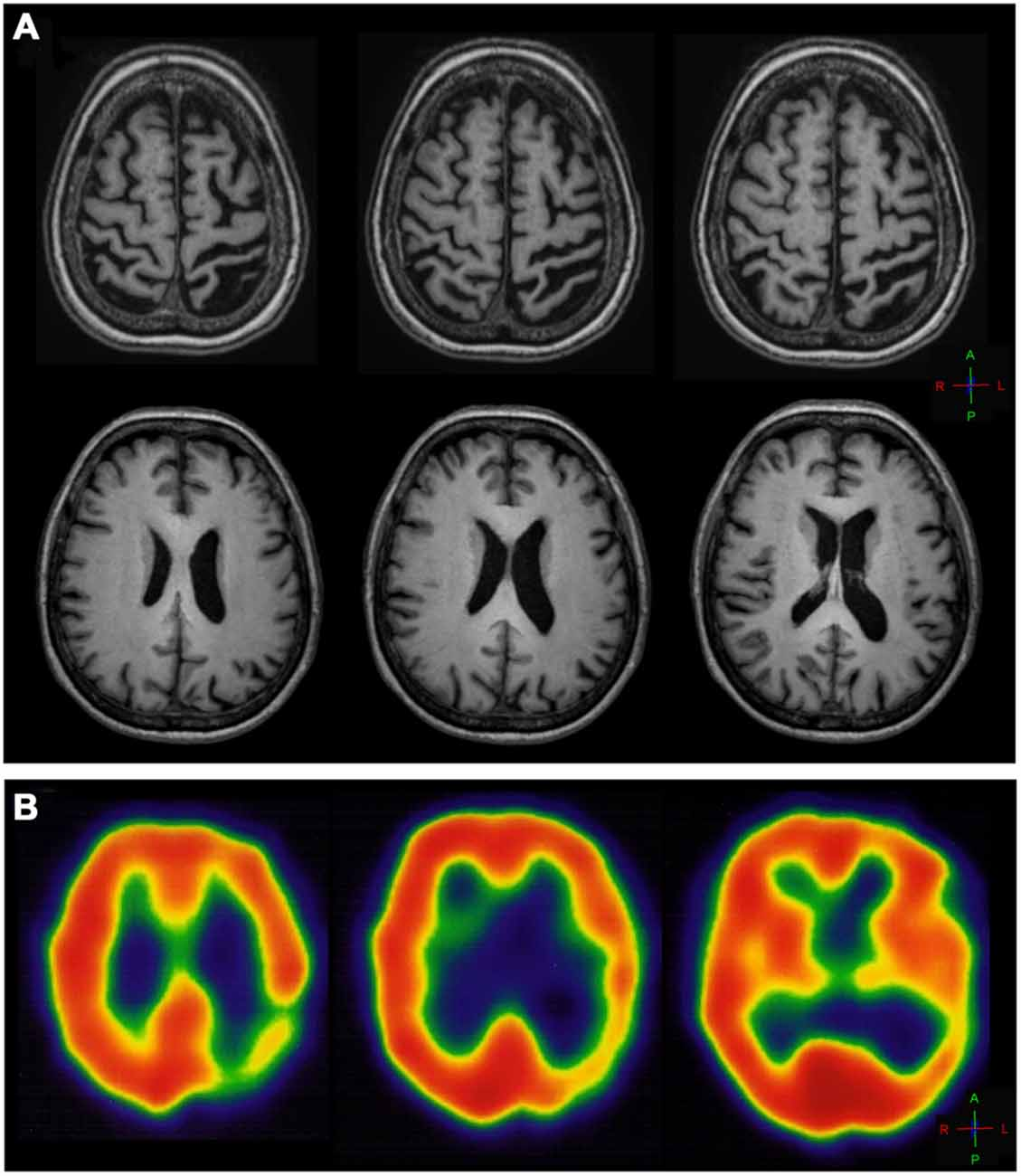 Frontiers | When Playing Is a Problem: An Atypical Case of Alien Hand ...