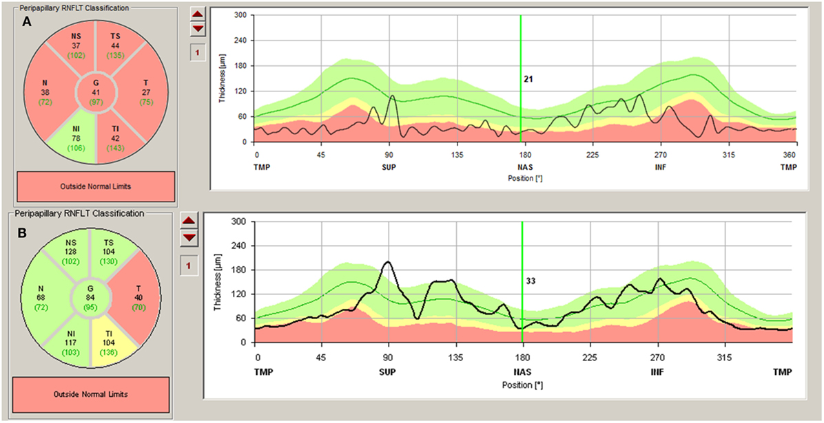 Frontiers | The Contribution of Optical Coherence Tomography in ...