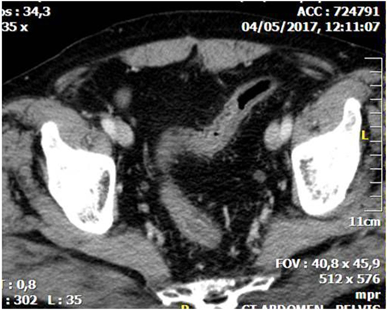 Frontiers | Advents in the Diagnosis and Management of Ischemic Colitis