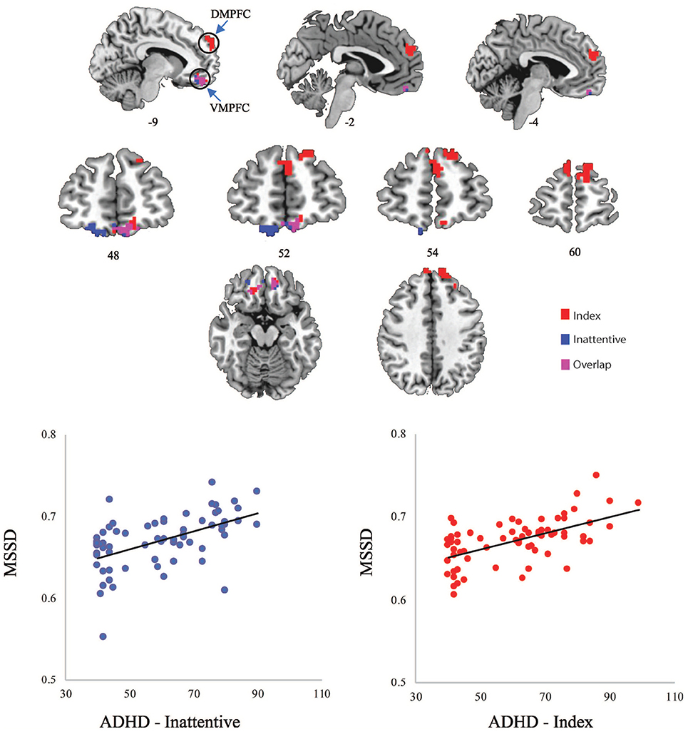 Frontiers | Resting-State Brain Signal Variability in Prefrontal Cortex ...