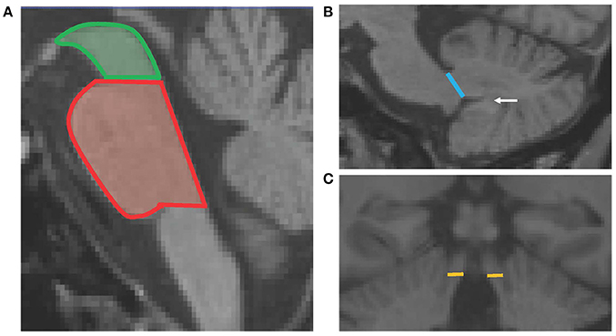 Frontiers | Middle Cerebellar Peduncle Width—A Novel MRI Biomarker for ...