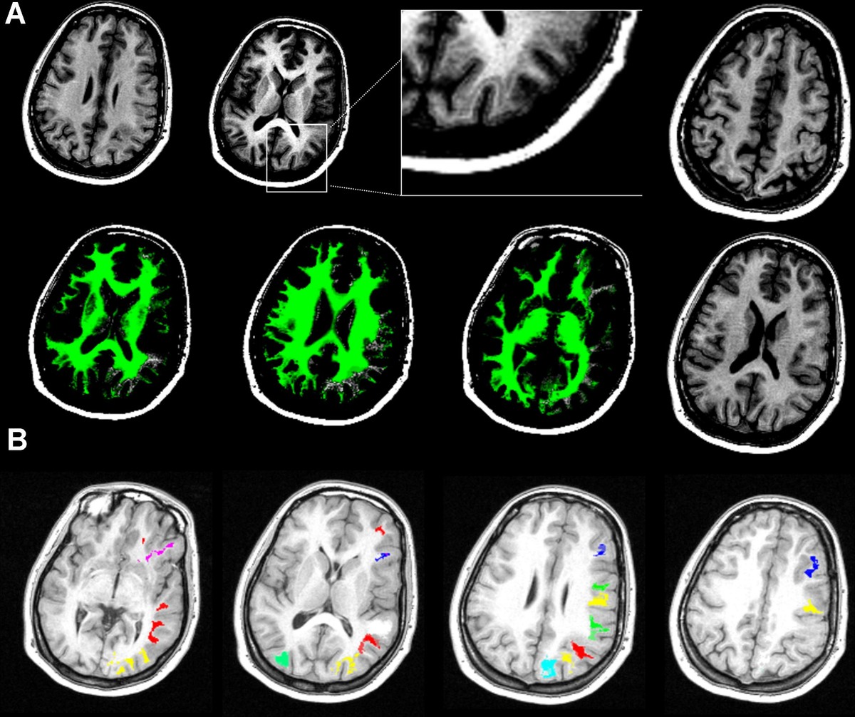 Frontiers | Functional Connectivity and Genetic Profile of a “Double ...