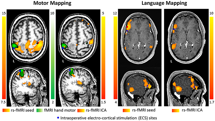 Frontiers | Pre-surgical Brain Mapping: To Rest or Not to Rest?
